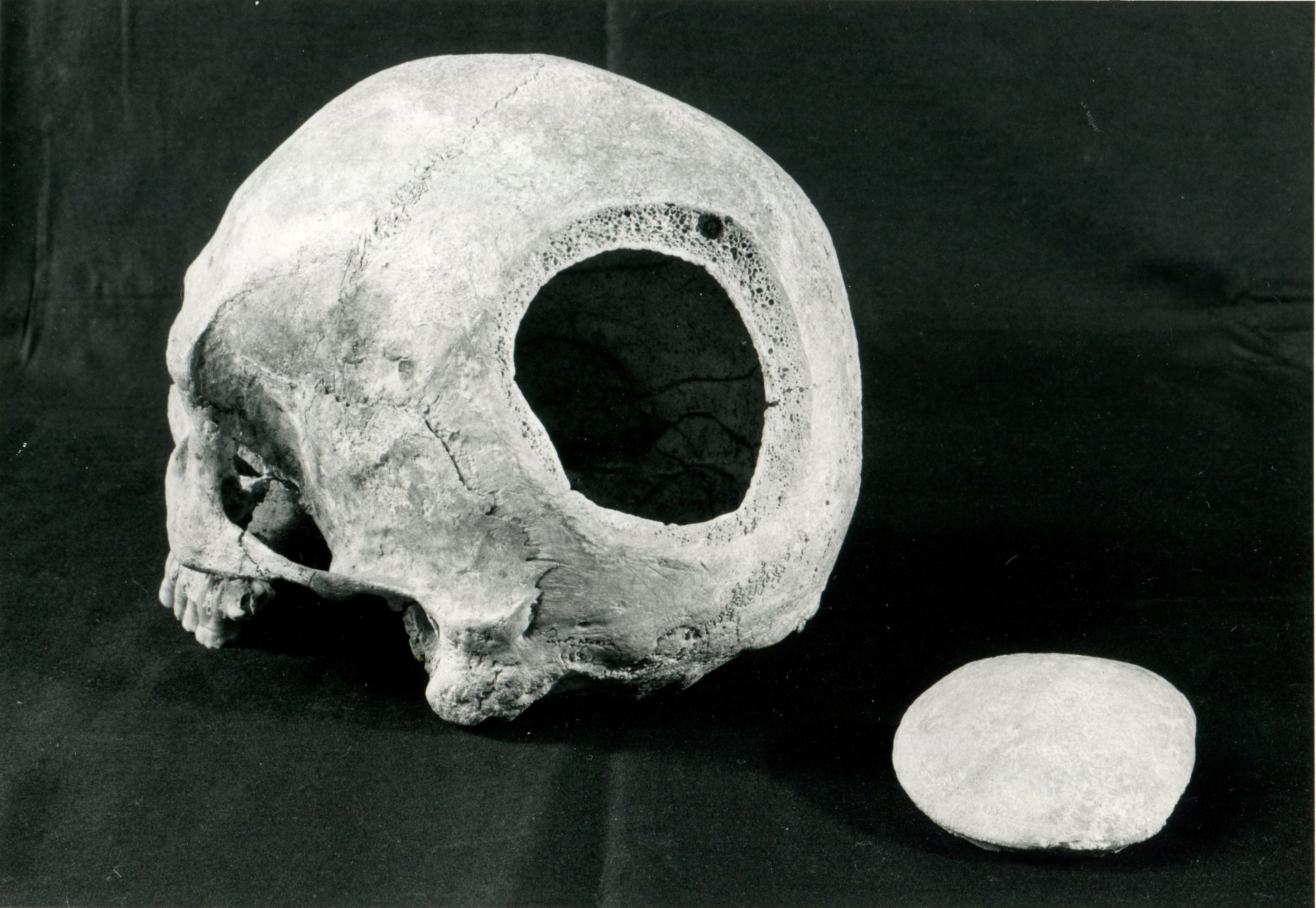 Trephination - #FolkloreThursday